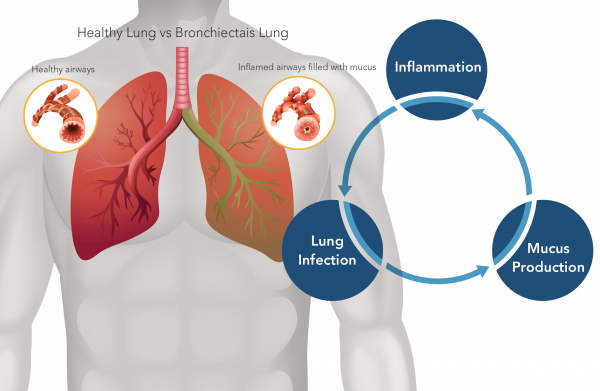 Treating Bronchiectasis - AffloVest