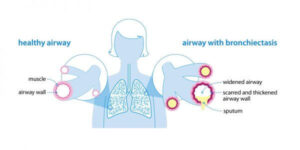 Bronchiectasis Symptoms, Diagnosis, Treatment - AffloVest