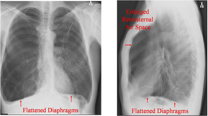 Disorders of the Diaphragm in COPD Patients - AffloVest