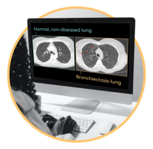 Bronchiectasis Symptoms, Diagnosis, Treatment - AffloVest